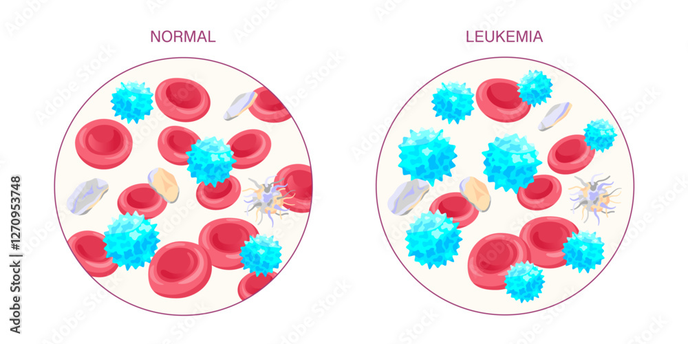 Leukemia Blood Cells Medical Illustrations. Normal And Leukemia Blood ...