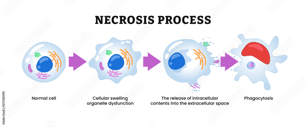 Necrosis process diagram infographic, labeled scheme with normal cell ...