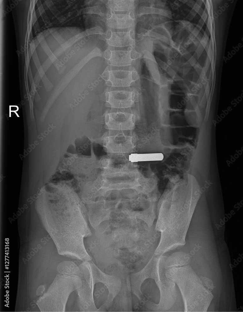 Child Abdominal Radiograph Bowel Obstruction and foreign body Stock ...