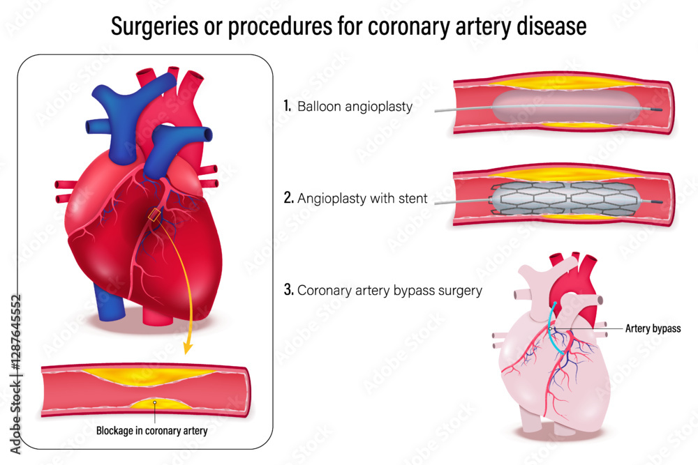 Surgeries or procedures for coronary artery disease. Balloon angioplasty, Angioplasty with stent ...