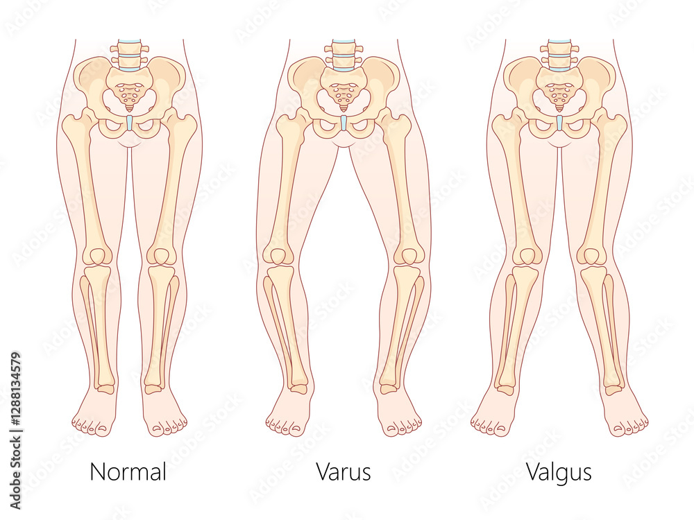 differences between normal leg alignment, varus bowlegged, and valgus knock-knees conditions ...