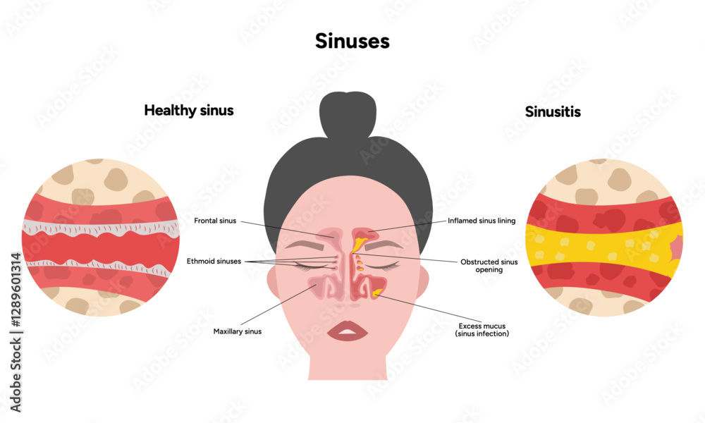 Sinuses anatomy healthy sinus and sinusitis. Nose nasal anatomy ...