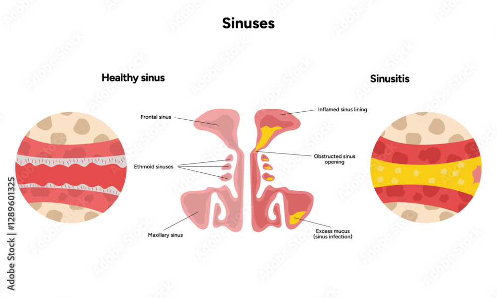 Sinuses anatomy healthy sinus and sinusitis. Nose nasal anatomy ...