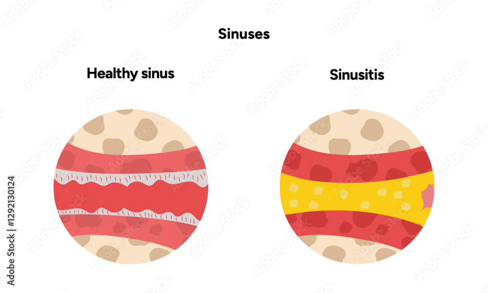 Sinuses anatomy healthy sinus and sinusitis. Nose nasal anatomy ...