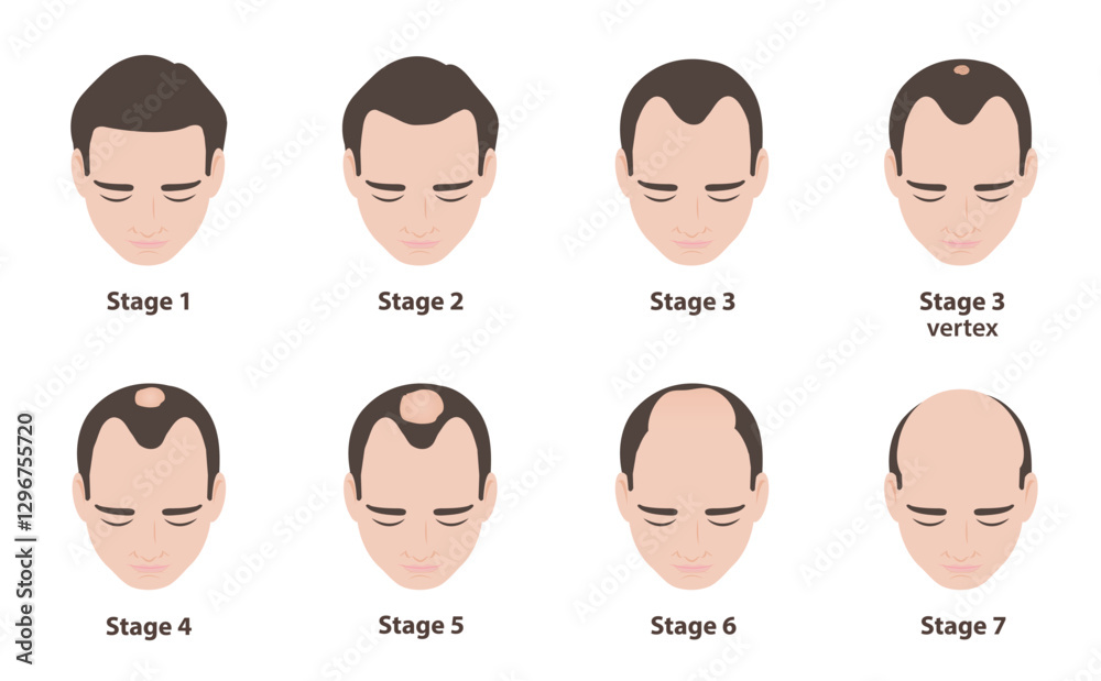 Infographic of the norwood scale for male pattern baldness illustration on white background ...