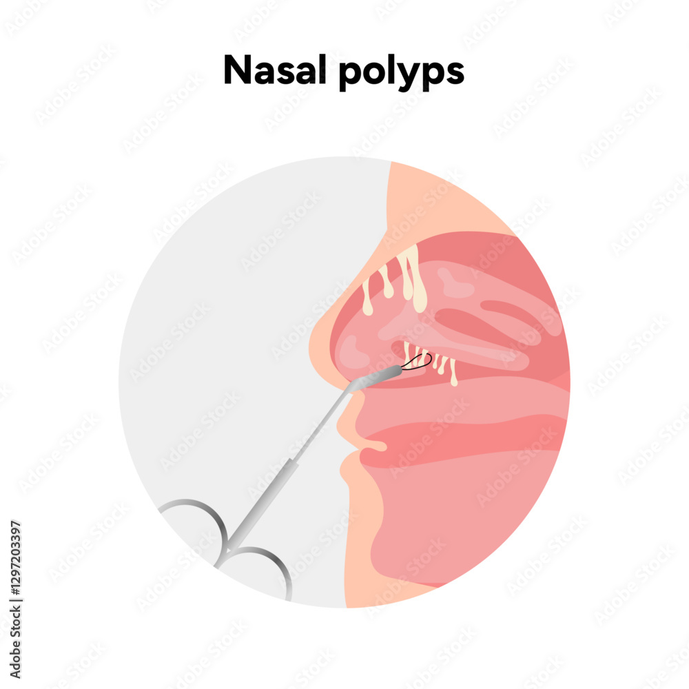 Nasal polyps, nose disease. Diagnostic and treatment. Medical diagram ...
