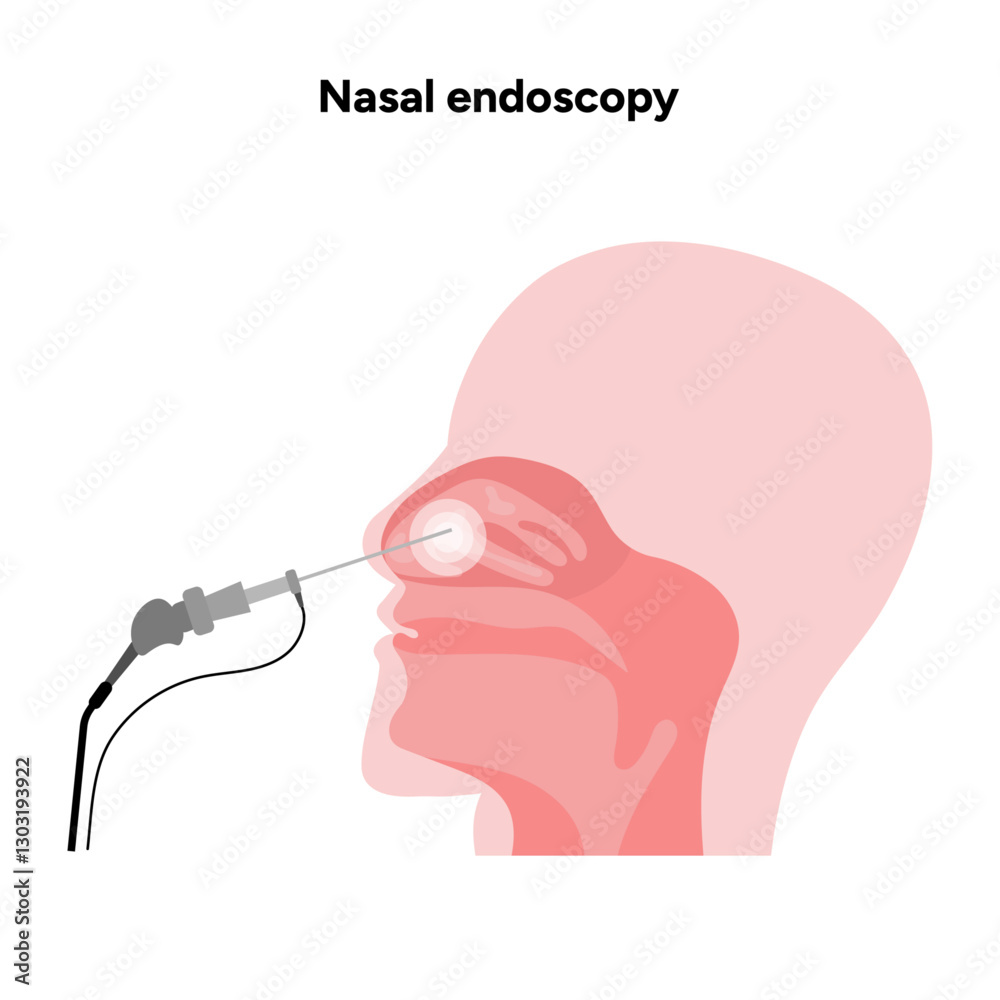 Nasal endoscopy procedure nasal and sinus passages. Thin, flexible tube ...
