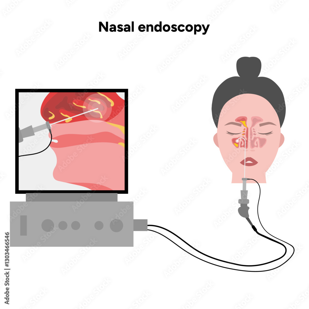 Nasal endoscopy procedure nasal and sinus passages. Thin, flexible tube ...