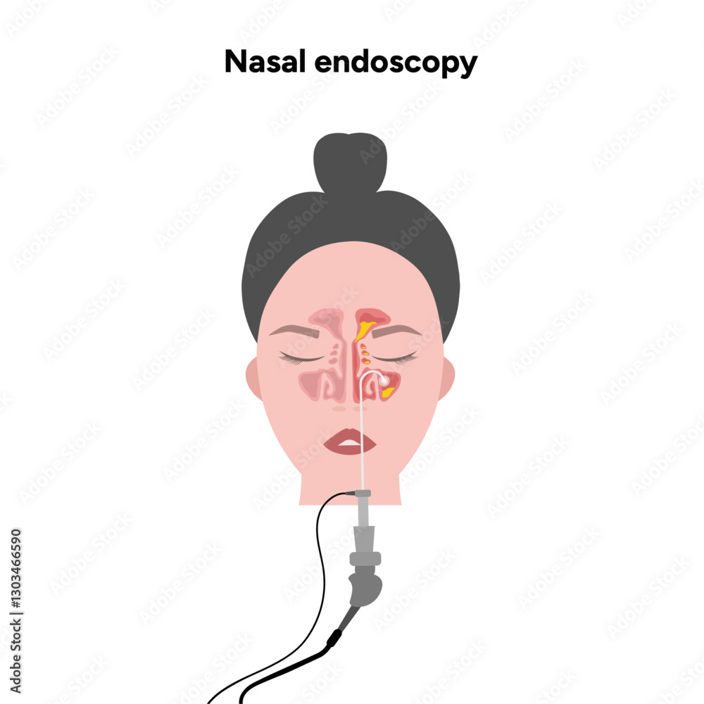 Nasal endoscopy procedure nasal and sinus passages. Thin, flexible tube ...