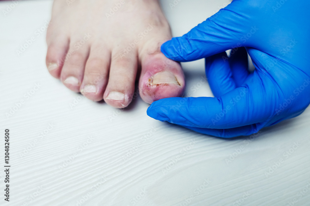 Stock-Foto „Finger infection. Paronychia, onychomycosis, nail psoriasis ...