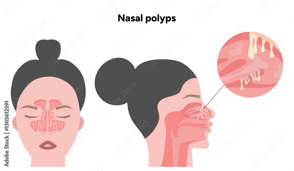 Nasal polyps, nose disease. Diagnostic and treatment. Medical diagram ...