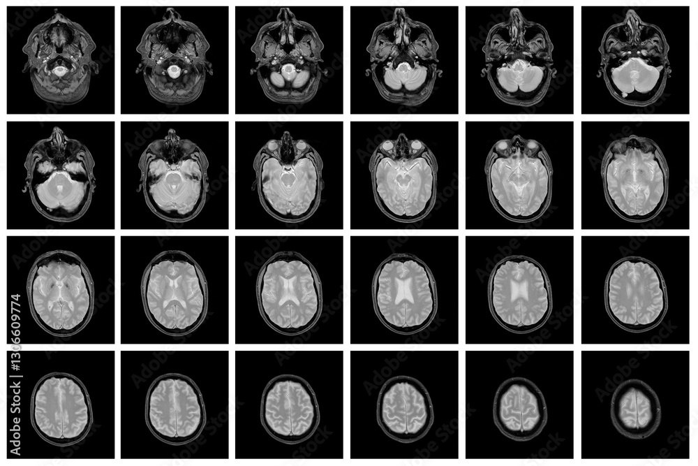 1 of the 12 Magnetic Resonance images series of a 67yo man. MRI brain and brainstem: axial ...