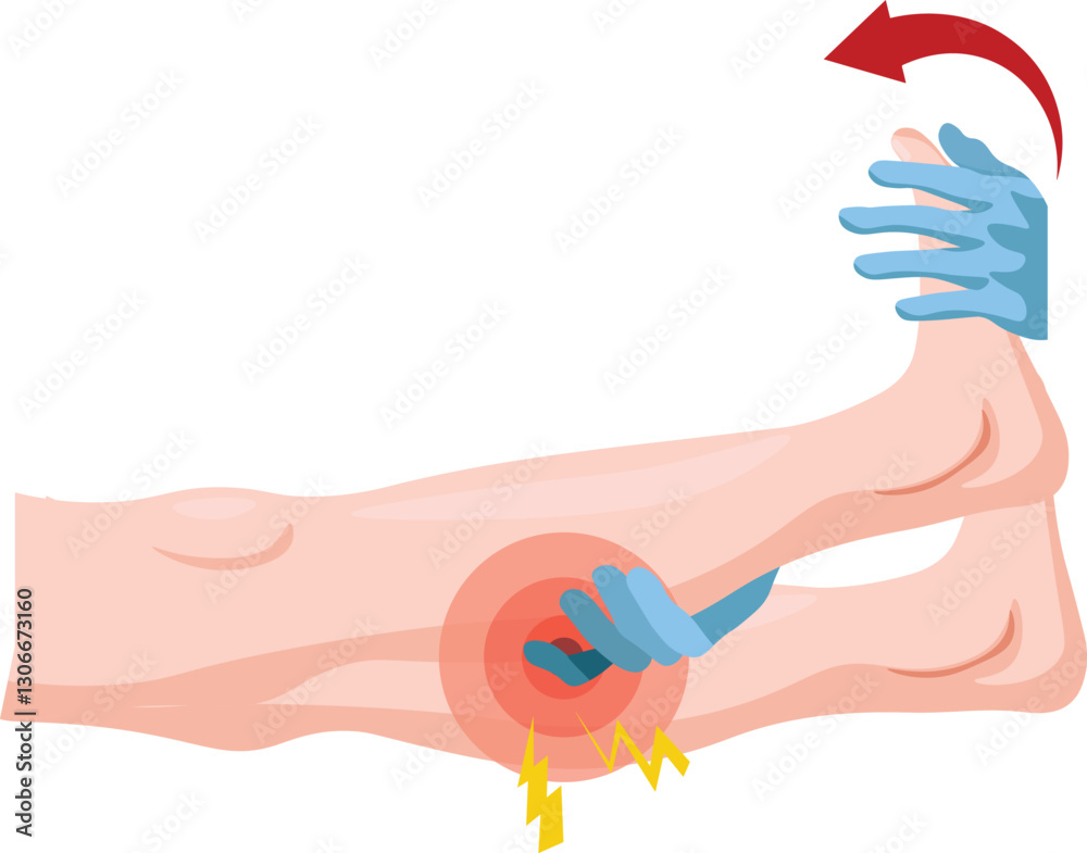 Homans' sign involves forcing the foot to dorsiflex while squeezing the ...