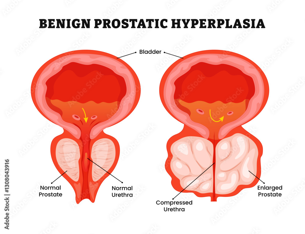 Benign prostatic hyperplasia anatomy, medical illustration poster, Enlarged prostate and normal ...