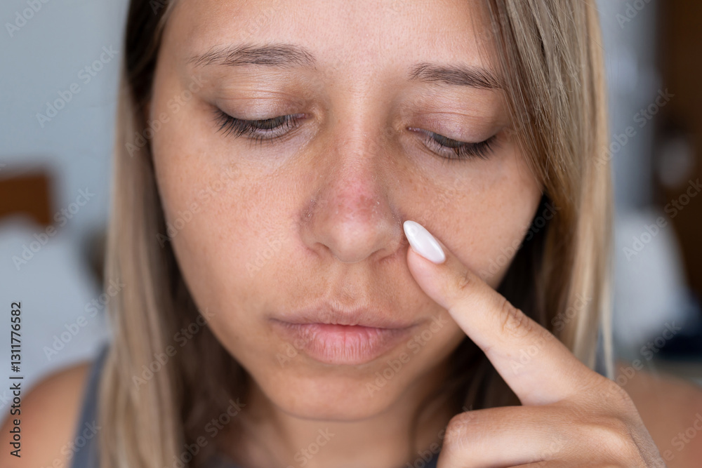 Foto de Stock Young woman pointing at her sunburned nose with peeling ...
