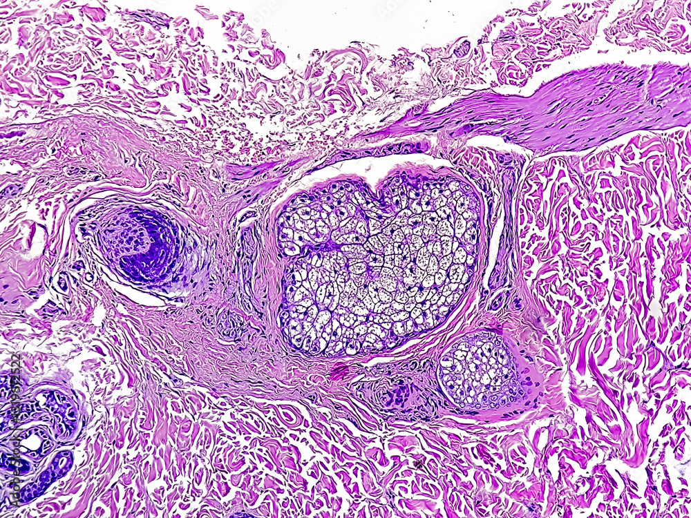Foto de Stock Photomicrograph showing keratosis of the Skin ...