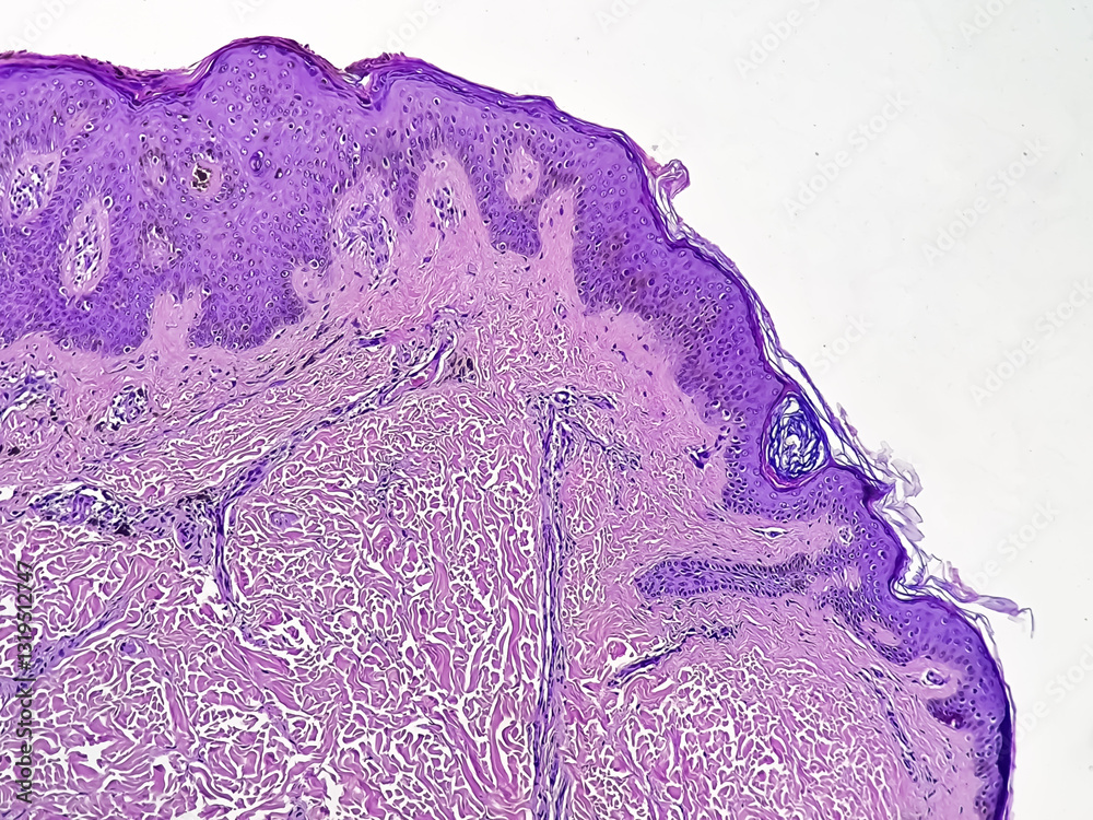 Foto de Stock Photomicrograph showing keratosis of the Skin ...