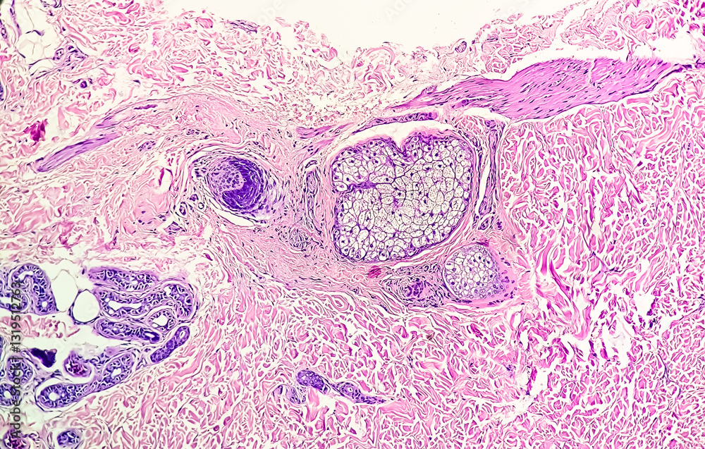 Fotografie Photomicrograph showing keratosis of the Skin, hematoxylin ...