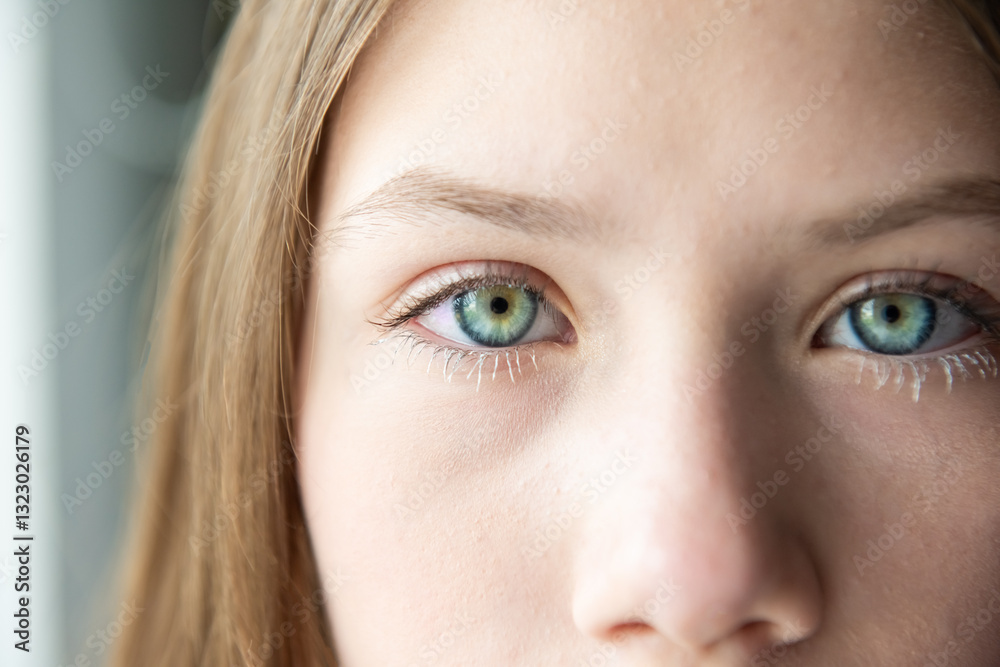 Stye, hordeolum, bacterial infection of oil gland in eyelid ...