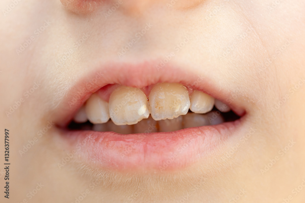 Close up of a child's smile revealing teeth affected by ...