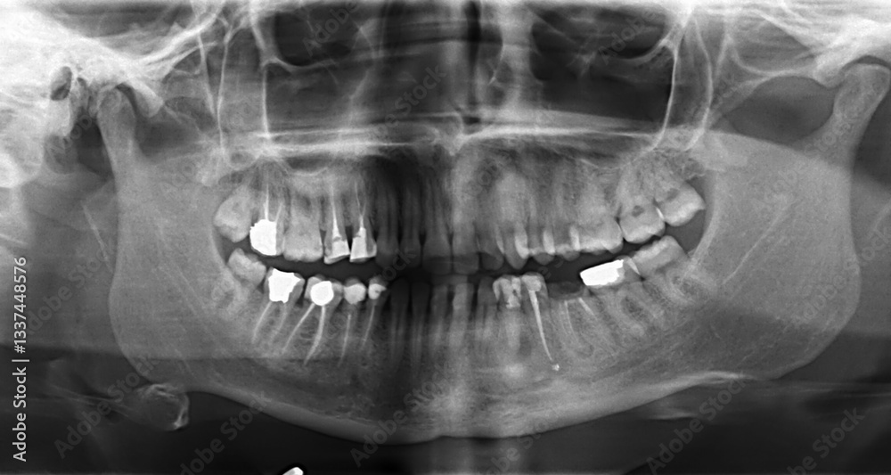 Dental X-ray showing teeth and jawbone in grayscale. Full mouth ...
