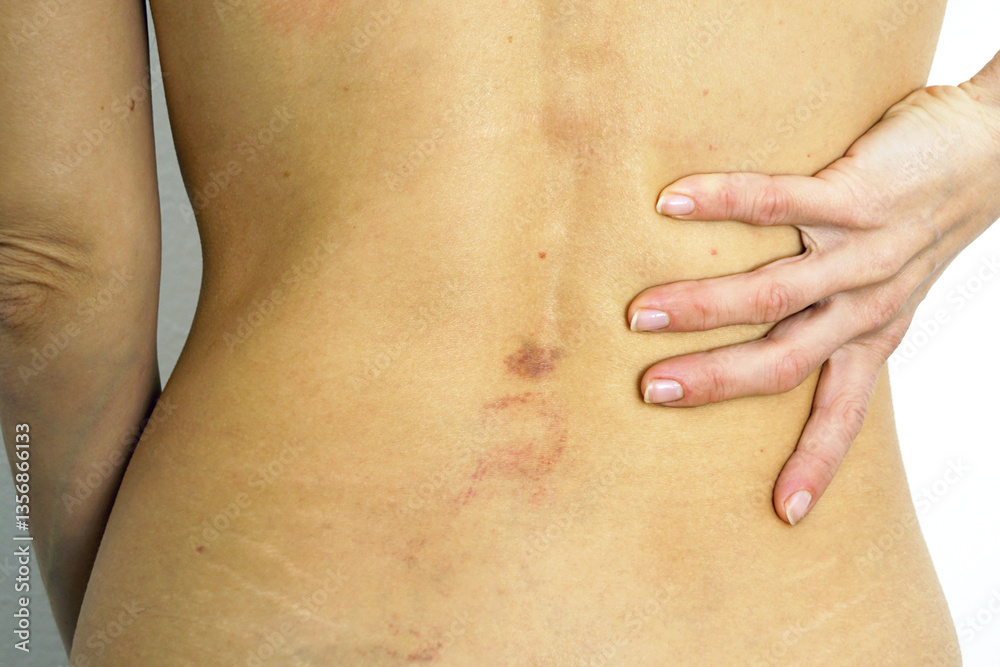 Consequences of domestic violence: bruises on a woman's body. Hematomas on her back. Close-up of ...