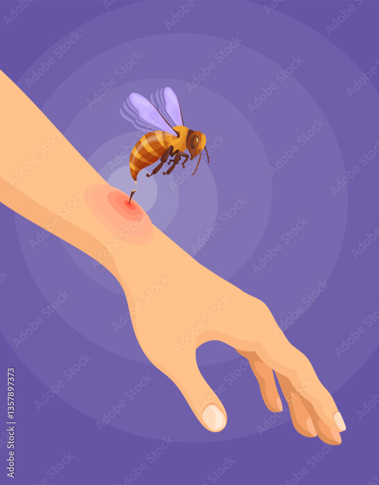 Bee sting. Bees wasp hornet bumblebee bites on skin danger allergy ...