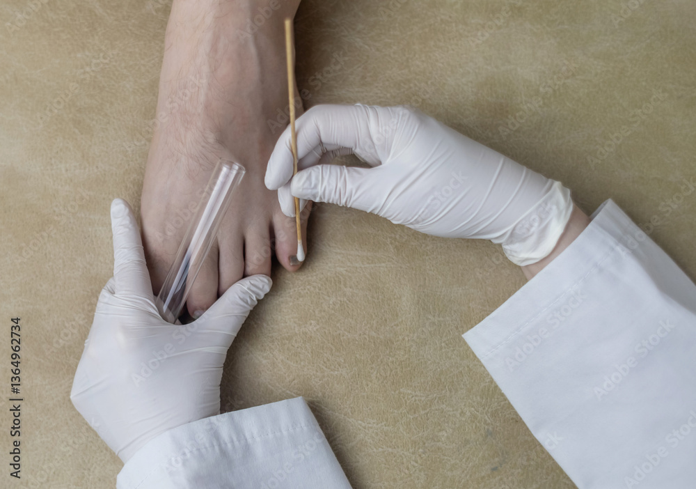 Dermatologist using a cotton swab and test tube to take a swab sample ...