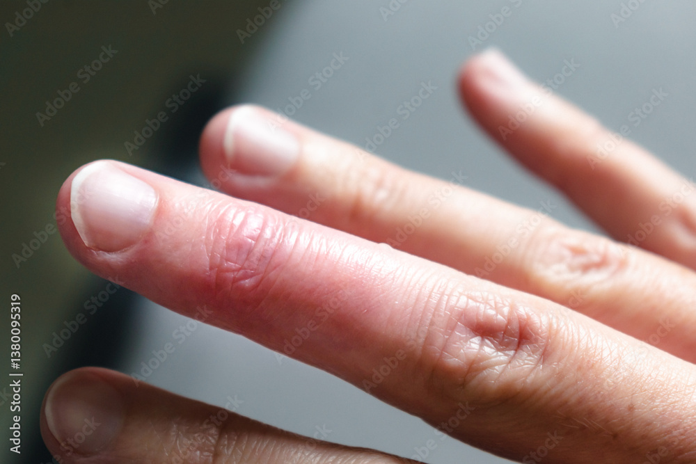 Mallet finger healing after splint removal from middle finger following ...