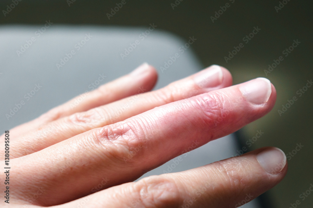 Mallet finger healing after splint removal from middle finger following ...