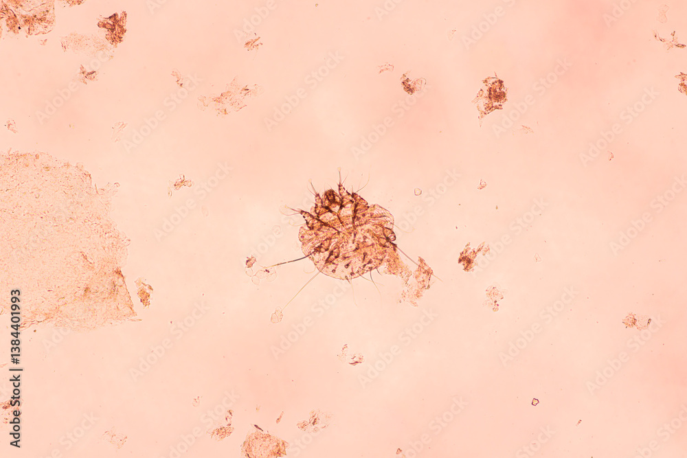Image of pubic lice in microscopy from urine specimen.Pthirus pubis or ...