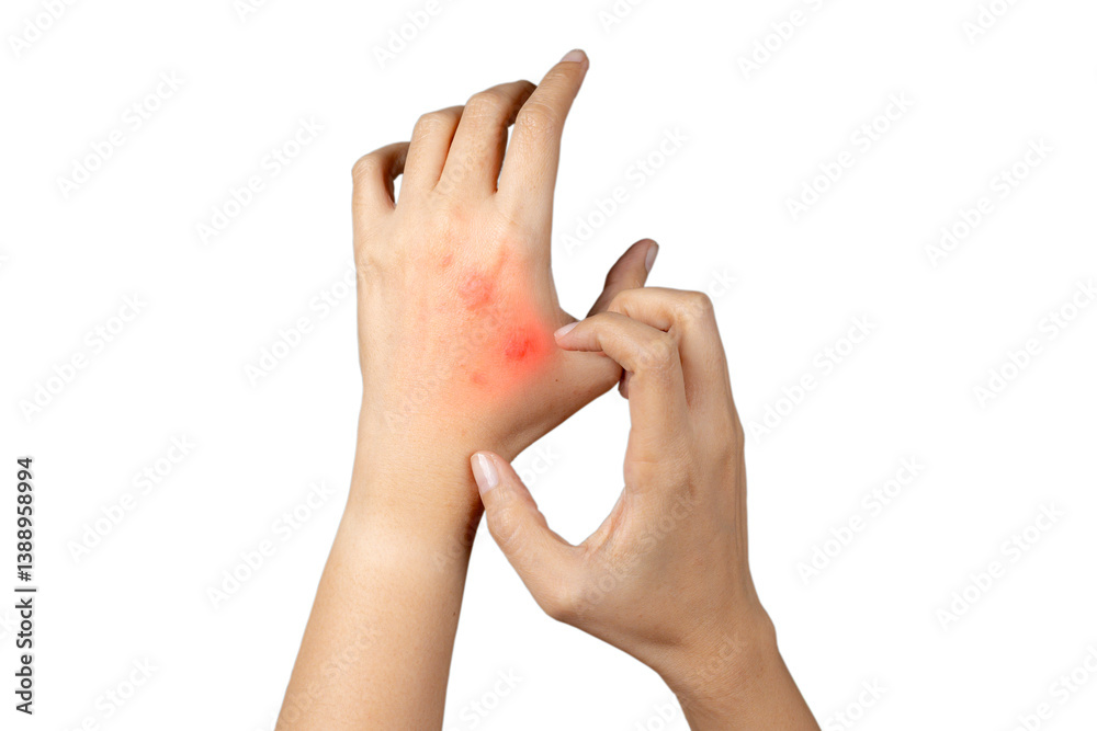 Eczema dermatitis on hands. red spots on the skin. dry skin The concept ...