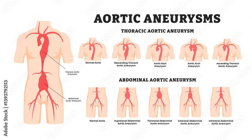 Different types of aortic aneurysm types, educational medical poster design infographic, labeled ...