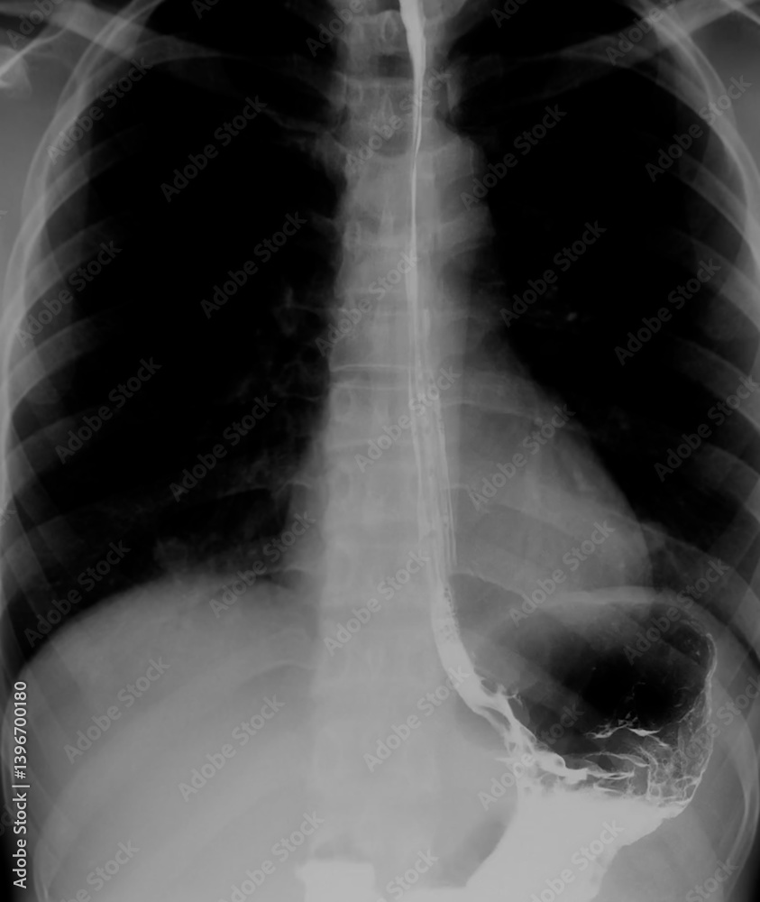 Ilustración de Stock Barium Swallow study test diagnose Barrett's GI ...