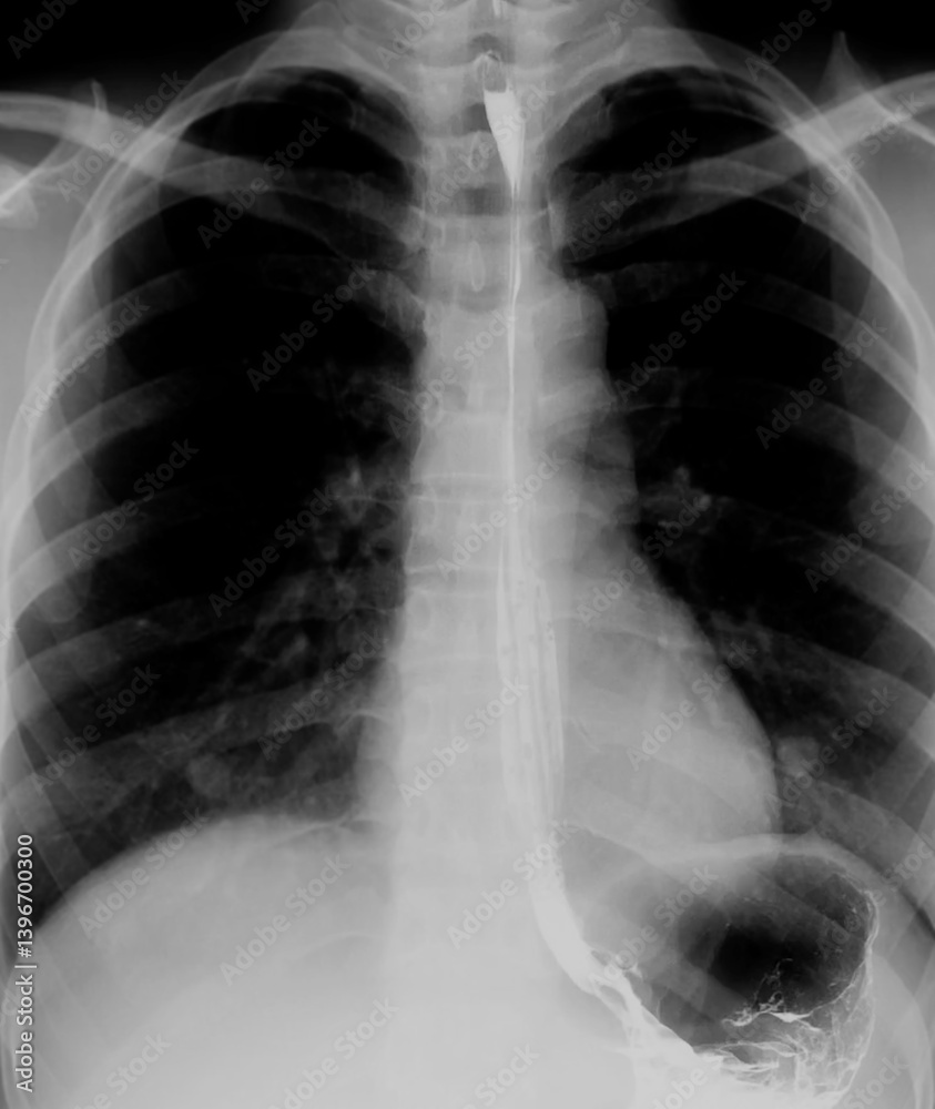 Barium Swallow study test diagnose Barrett's GI tract exam GERD ulcers ...