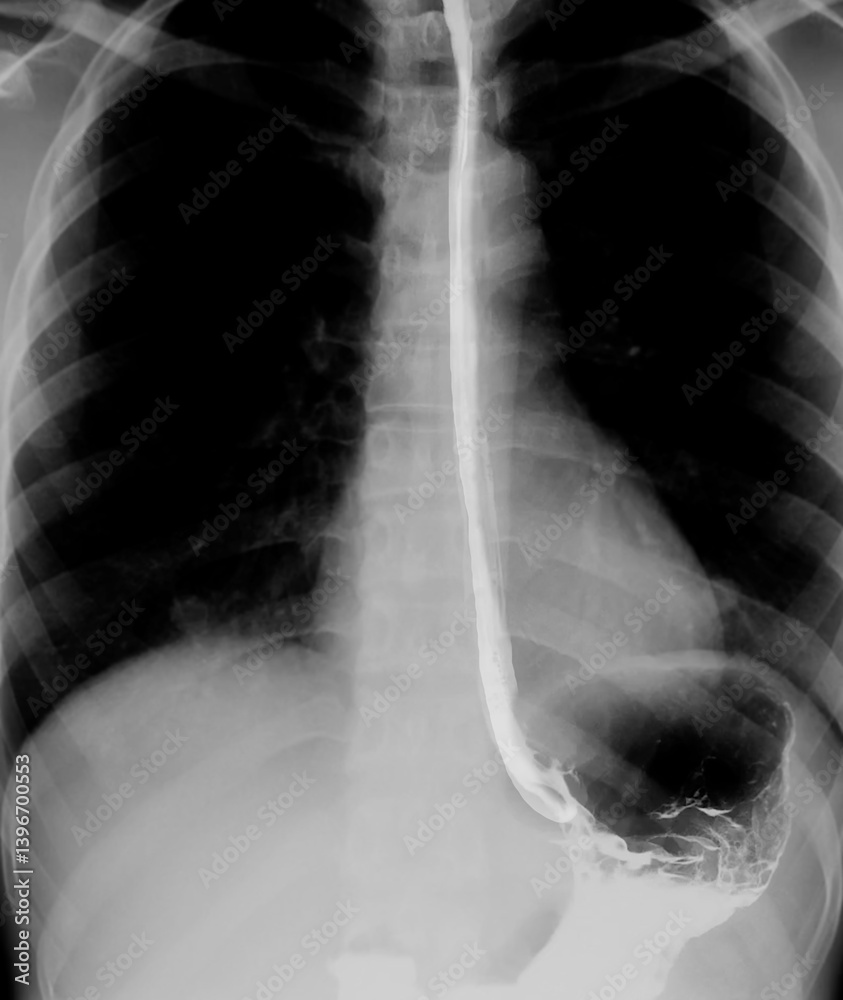 Barium Swallow study test diagnose Barrett's GI tract exam GERD ulcers ...