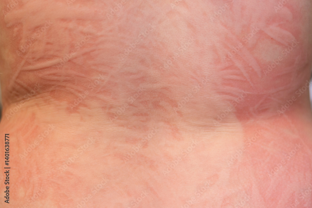 Understanding dermographism on skin, showcasing raised welts and ...