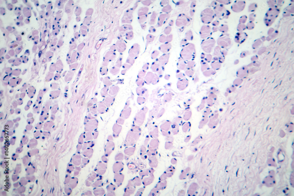 Skeletal muscle atrophy, photomicrograph showing decreased fiber size ...