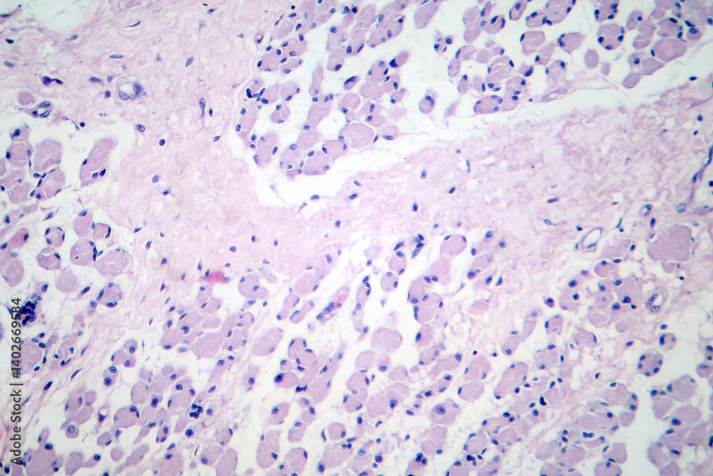 Skeletal muscle atrophy, photomicrograph showing decreased fiber size ...
