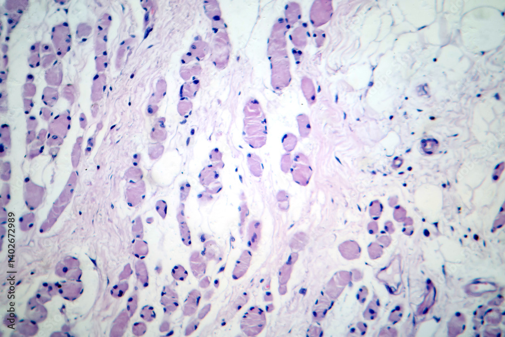 Skeletal muscle atrophy, photomicrograph showing decreased fiber size ...