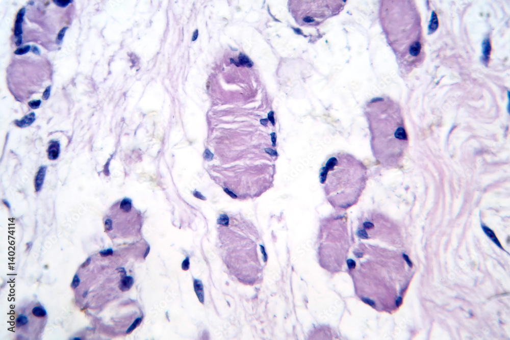 Skeletal muscle atrophy, photomicrograph showing decreased fiber size ...