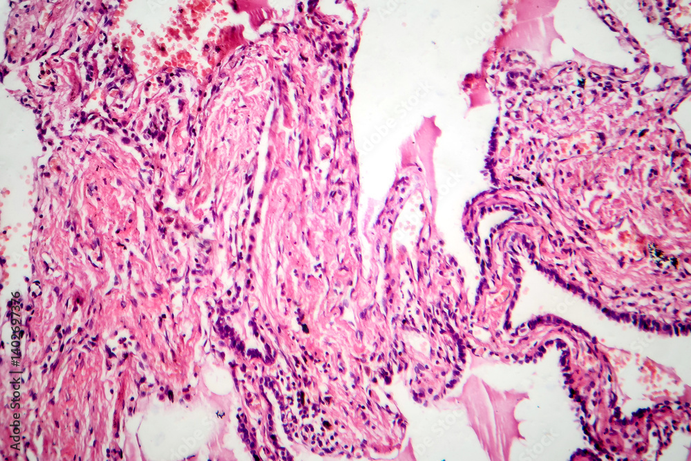 Red hepatization stage of lobar pneumonia, photomicrograph showing ...
