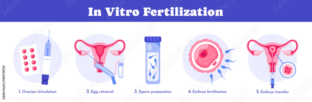 In vitro fertilization. Medical poster with Embryo development stages ...