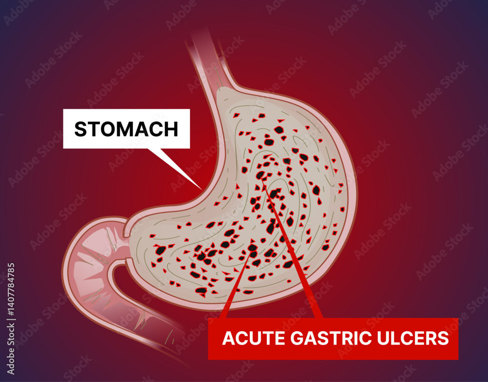 Unhealthy stomach. Acute gastric ulcers, gastritis. Gastroesophageal ...