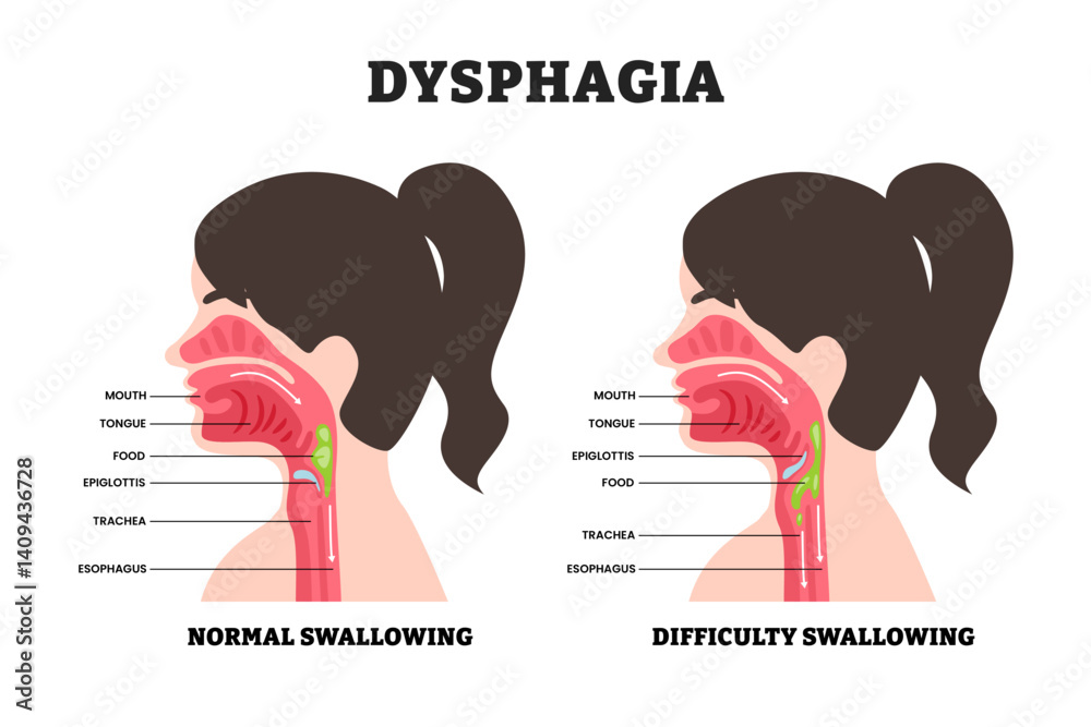 Esophageal dysphagia disorder, educational medical poster design healthcare scheme, labeled with ...