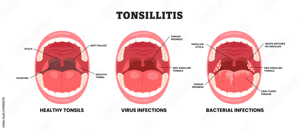Different types of tonsillitis types, educational medical poster design healthcare scheme ...