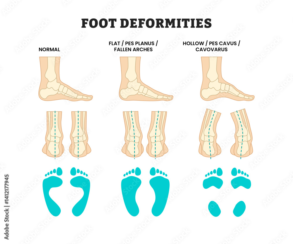 Different types of foot deformities types, educational medical poster design healthcare ...