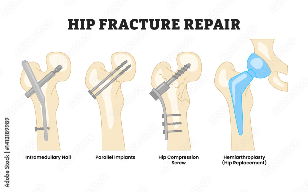 Different types of hip fracture repair types, educational medical ...
