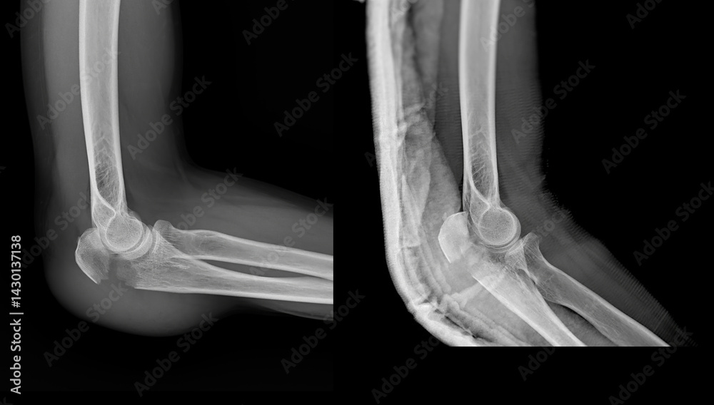 An X-ray image showing a fracture of the olecranon process of the ulna ...