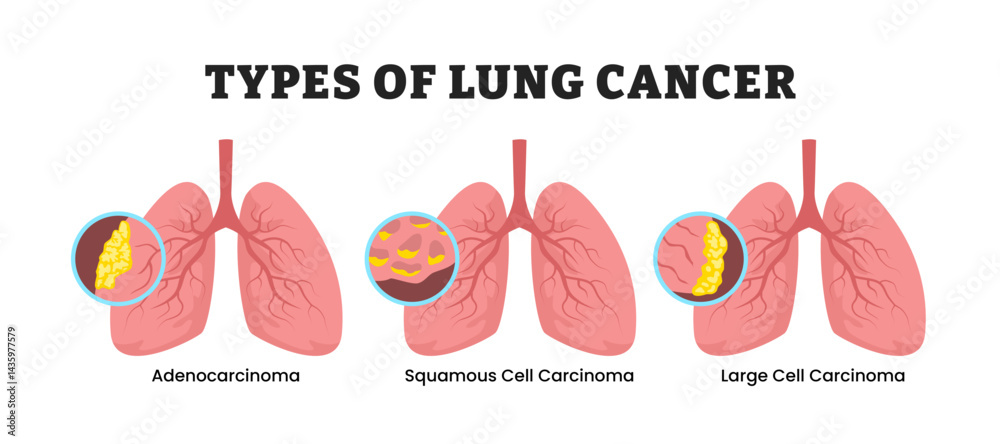 Different types of lung cancer types, educational medical poster design ...